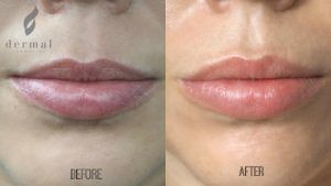 Lip Injections - Dermal Cosmetics