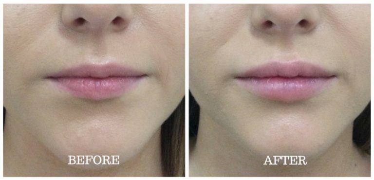 Lip Injections: Before and After - Dermal Cosmetics